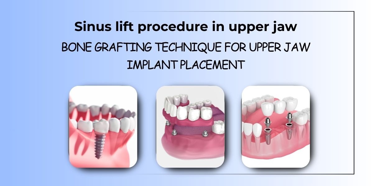 Sinus Lift Procedure: A Key Step for Upper-Jaw Implants